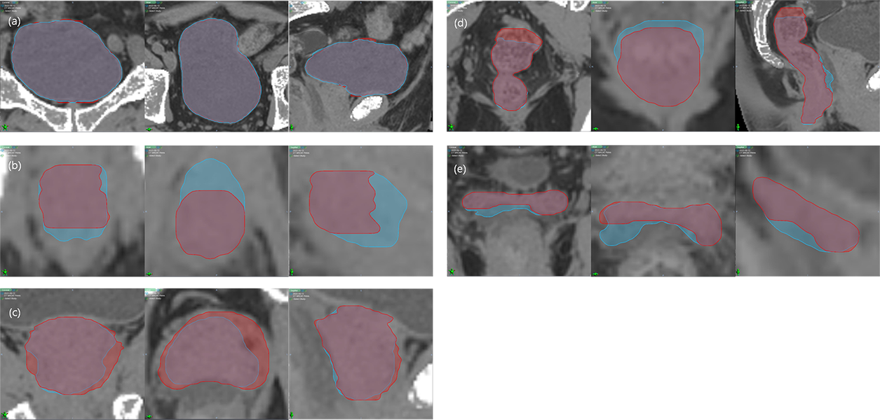 Contour+ performance on Male Pelvis synthetic CTs | MVision AI