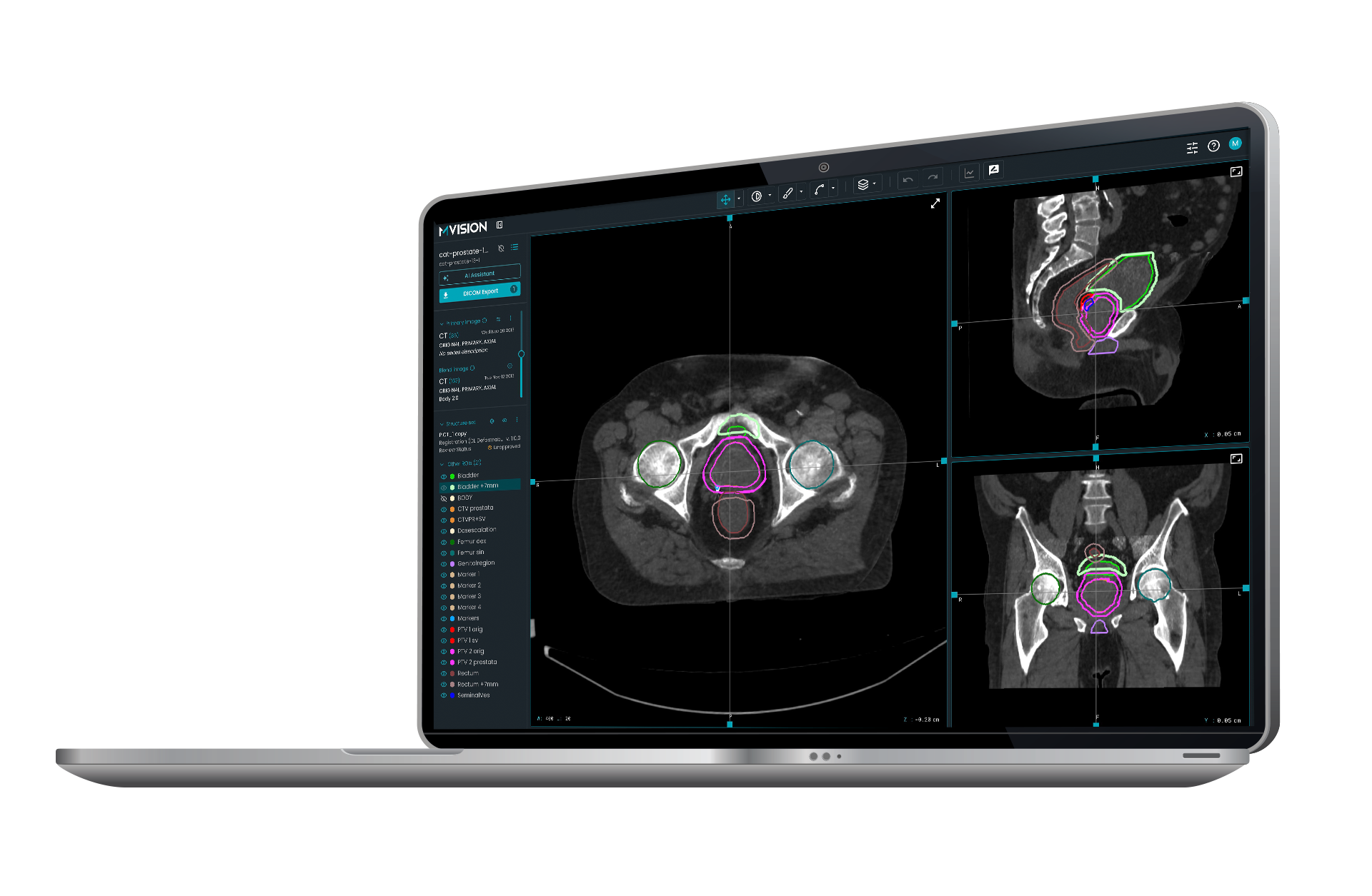 Workspace+ | Intelligent AI PlatformFor Radiotherapy | MVision AI